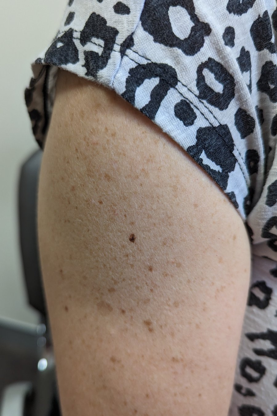 How would you manage this lesion on the upper arm?