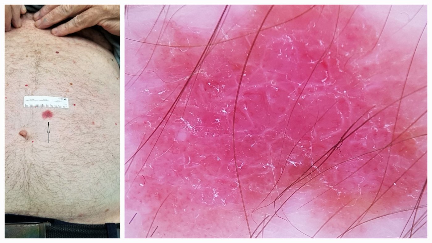 How would you manage this pink patch on the abdomen?