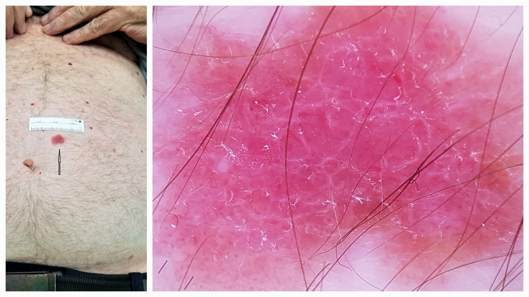 How would you manage this pink patch on the abdomen?