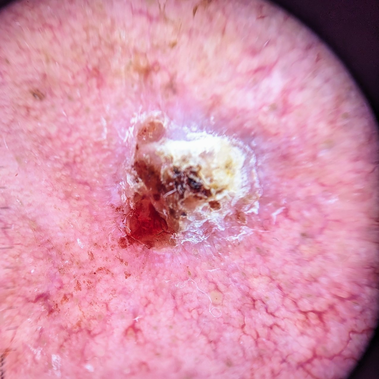 How would you manage this recurring lesion on the nose?