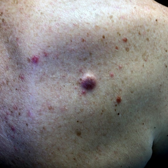 How would you manage this suspected cyst on the back?