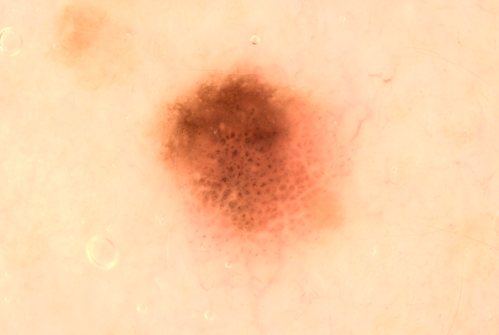 How would you treat this asymptomatic back lesion?
