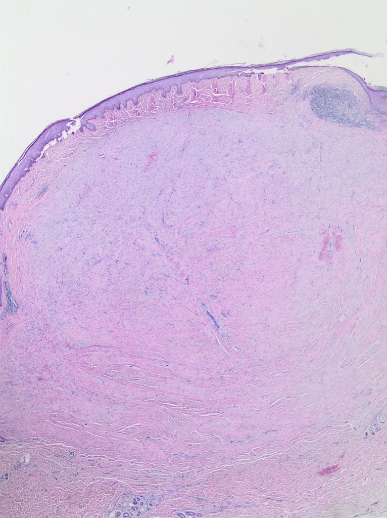 How would you treat this upper chest lesion?