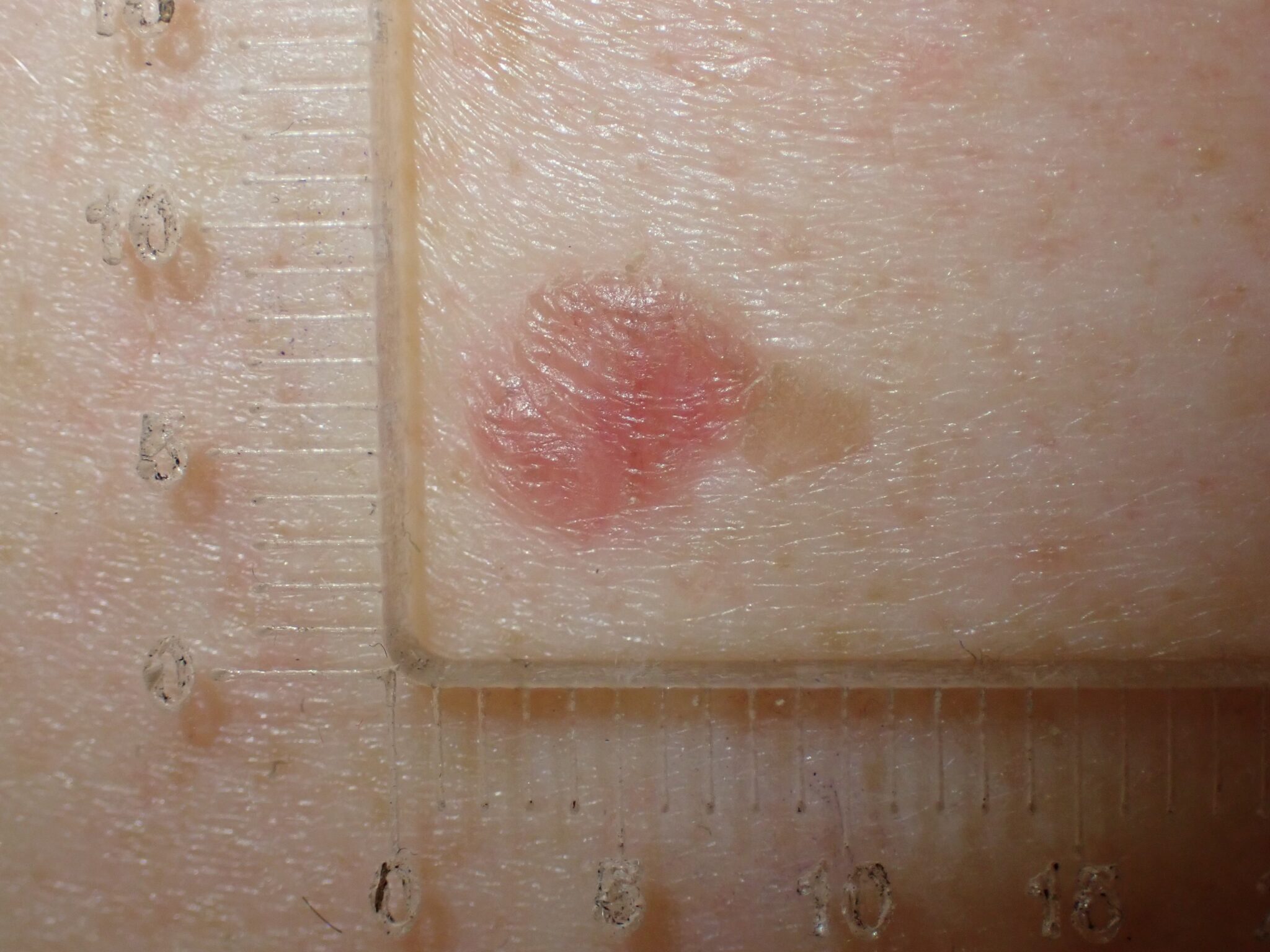 How would you treat this mid-back lesion?