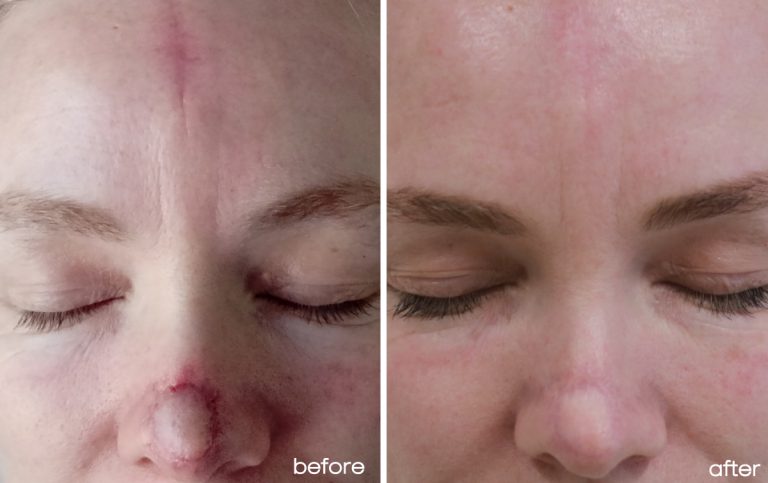 Minimising scarring after BCC removal