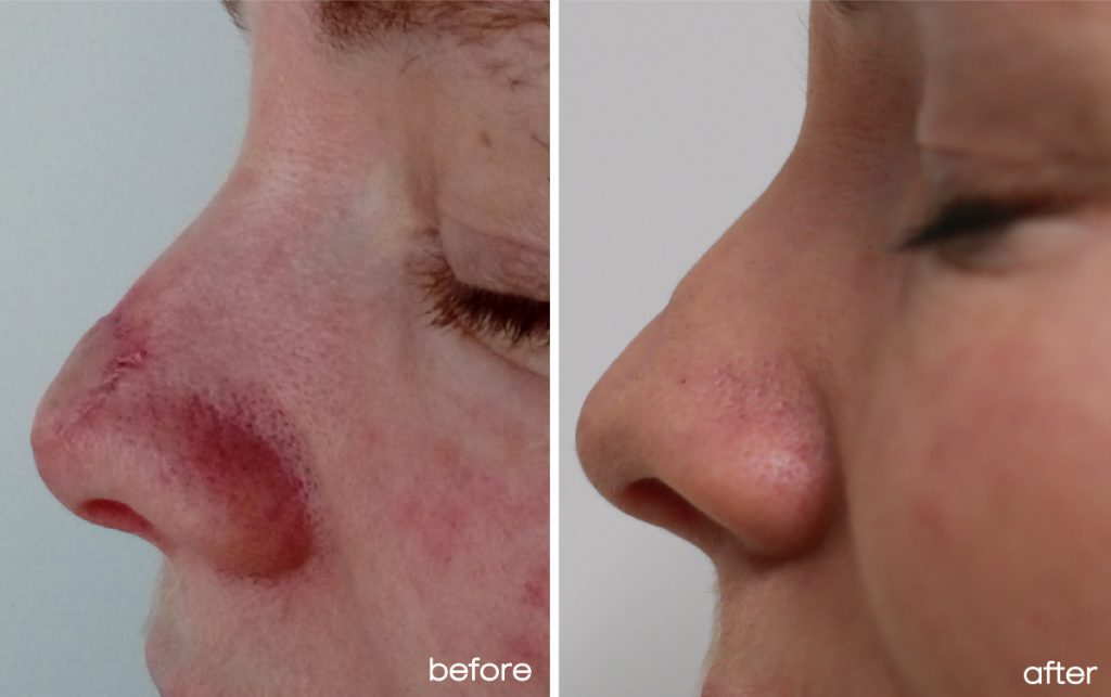 Minimising scarring after BCC removal