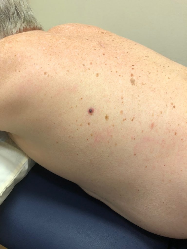 How would you treat this left posterior flank lesion?