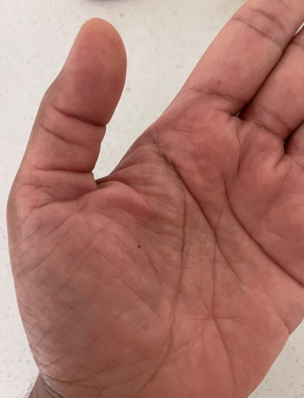 How would you treat this pigmented lesion on the hand?