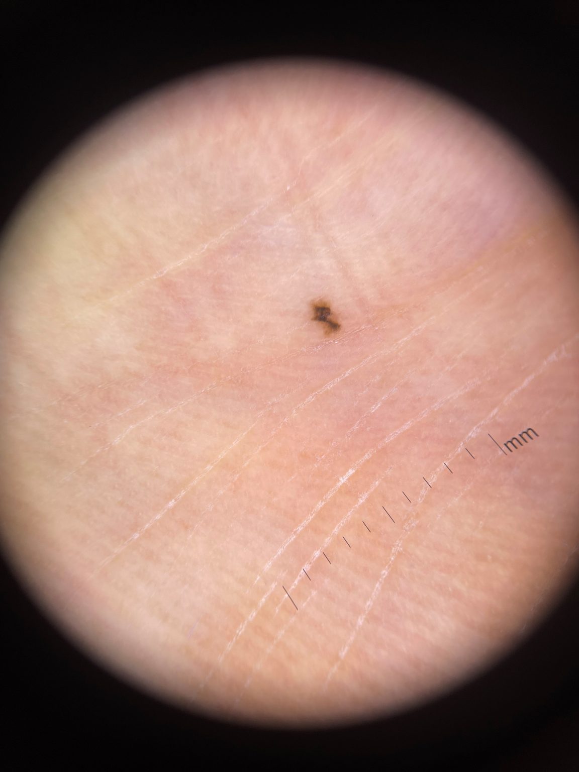 How would you treat this pigmented lesion on the hand?