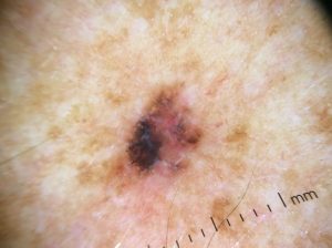How would you treat this lesion at the patient's first skin check?